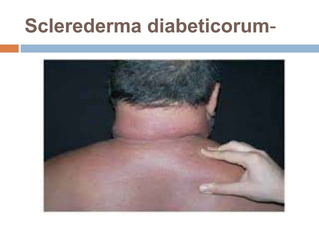 Cutaneous manifestations of endocrine disease | PPTX