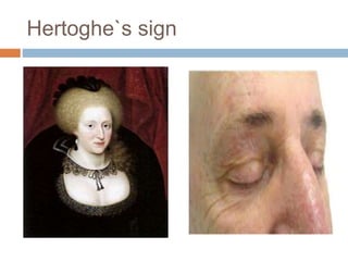 Cutaneous manifestations of endocrine disease | PPT