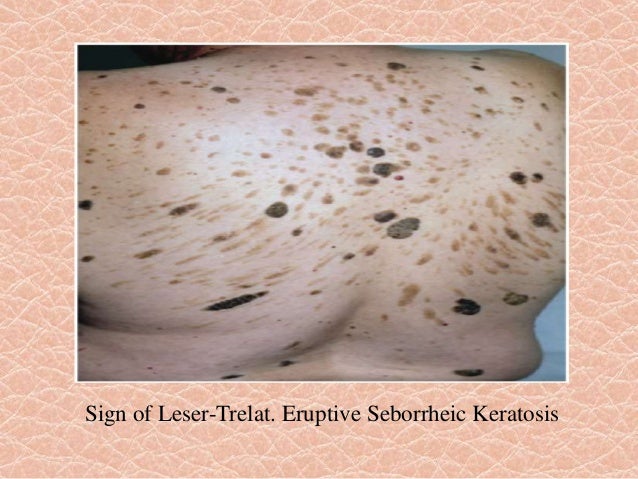 Cutaneous Manifestations of GI Malignancies