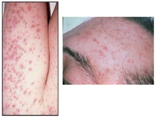 Hiv Rashes On Face