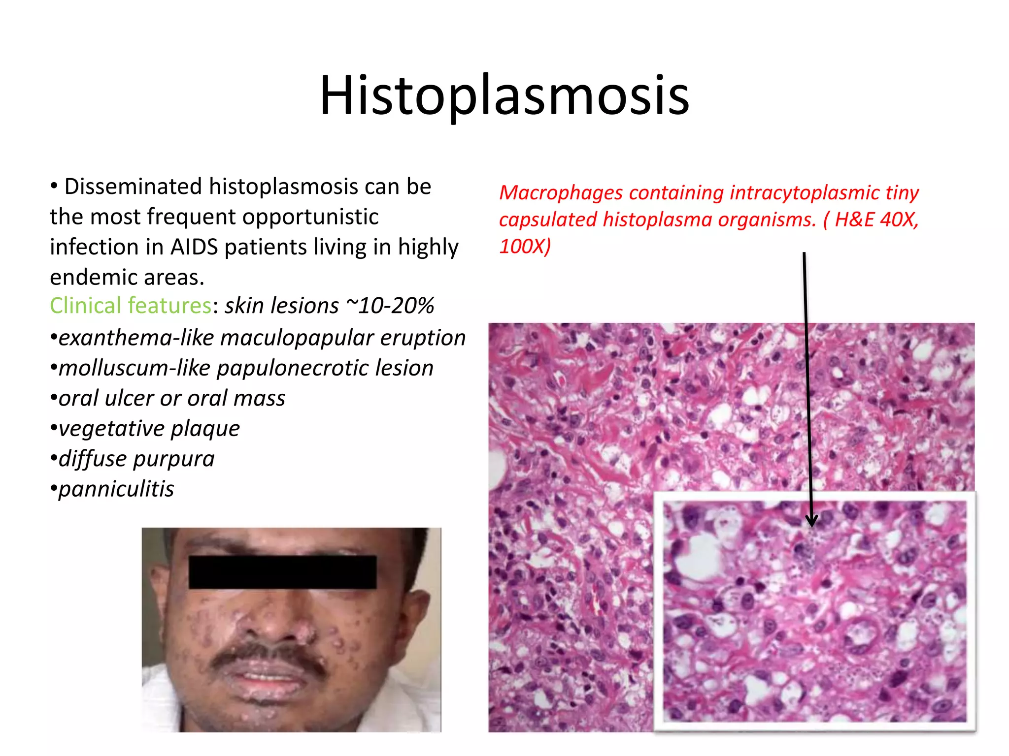 Cutaneous manifestations of hiv infection | PPTX