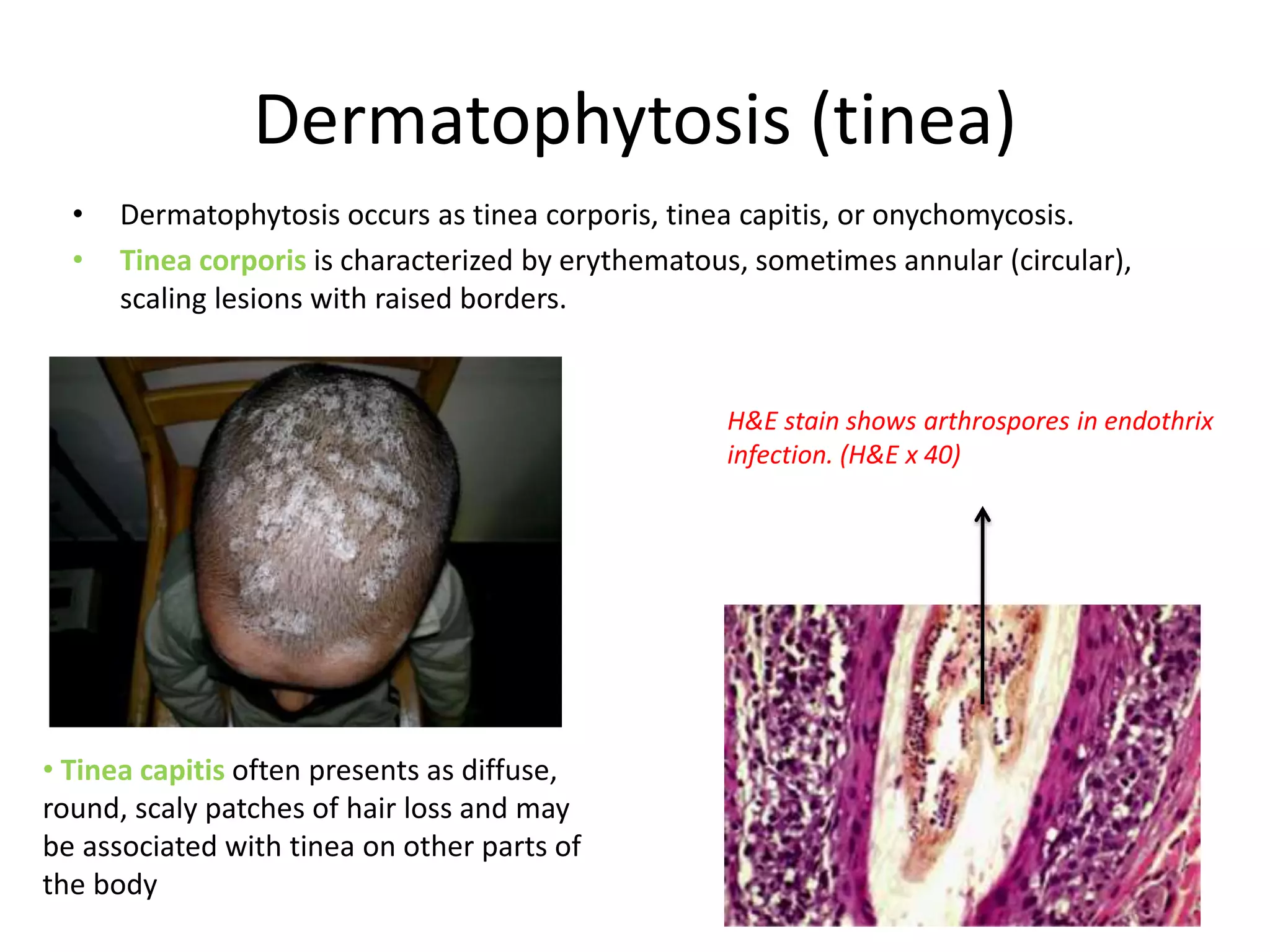 Cutaneous manifestations of hiv infection | PPTX
