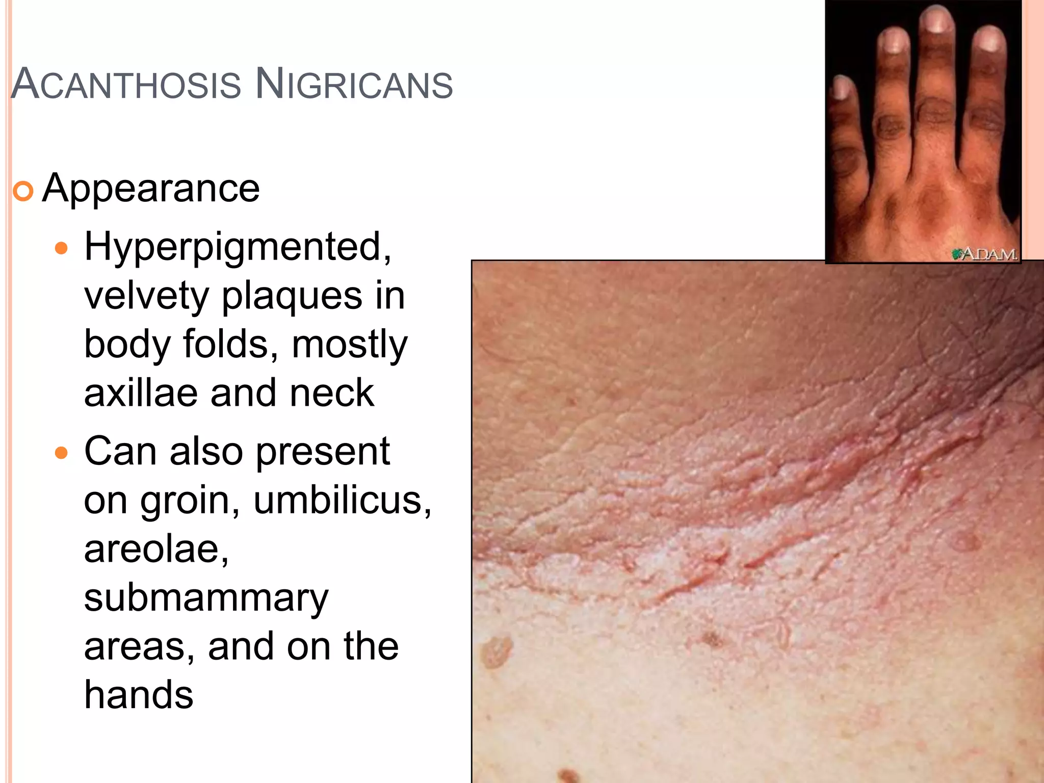 Cutaneous manifestations of internal diseases | PPTX