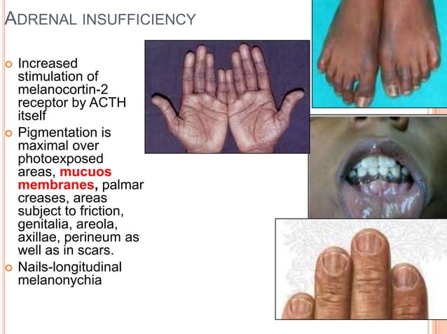 Cutaneous manifestations of internal diseases | PPTX | Thyroid ...