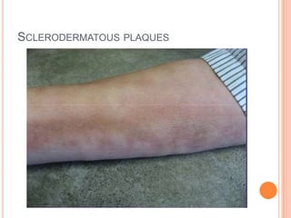 Cutaneous manifestations of internal diseases | PPTX