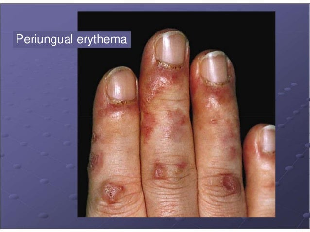 Cutaneous manifestations of internal diseases