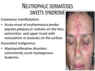 Cutaneous manifestations of internal malignancies. | PPTX