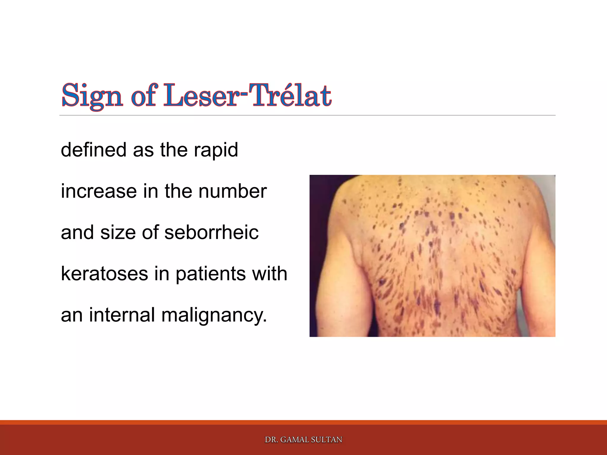 Cutaneous manifestations of internal malignancy and paraneoplastic ...