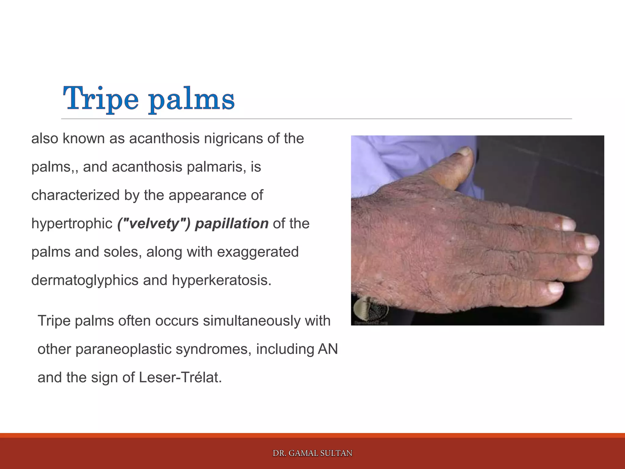 Cutaneous manifestations of internal malignancy and paraneoplastic ...