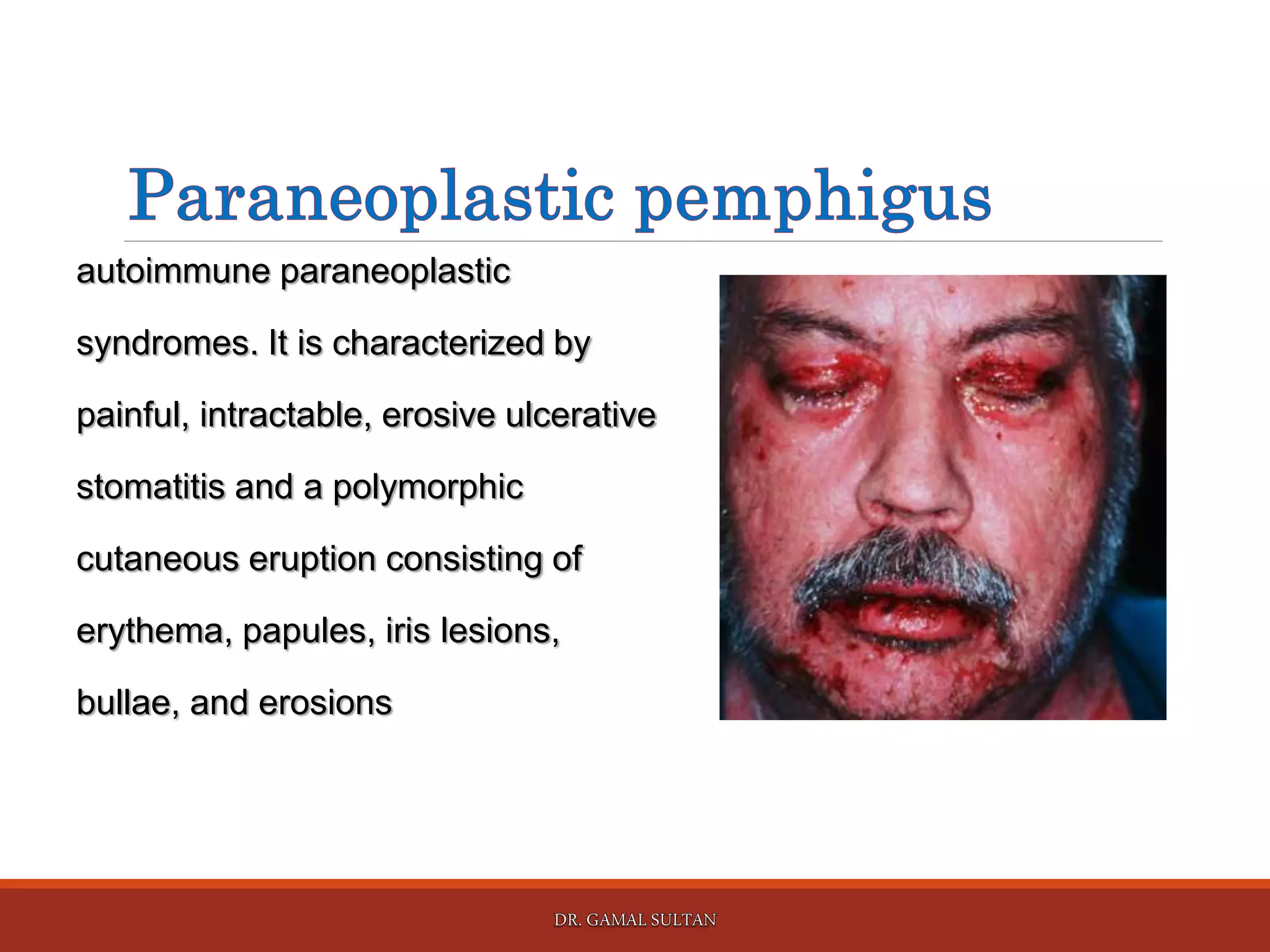 Cutaneous manifestations of internal malignancy and paraneoplastic ...