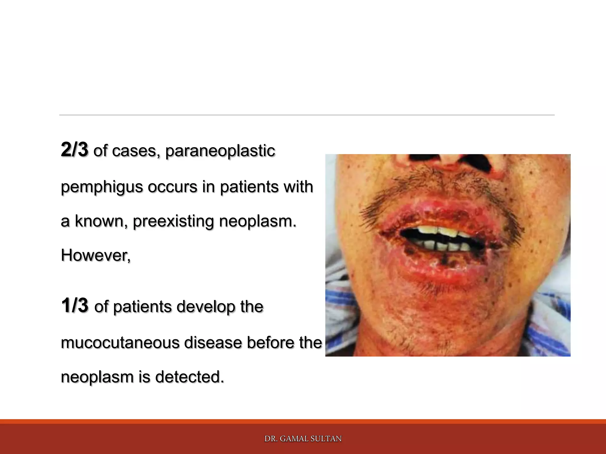 Cutaneous manifestations of internal malignancy and paraneoplastic ...