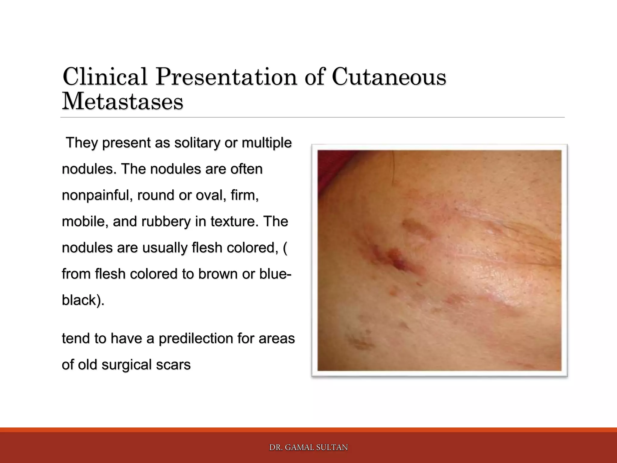 Cutaneous manifestations of internal malignancy and paraneoplastic ...