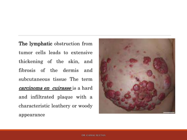 Cutaneous manifestations of internal malignancy and paraneoplastic ...