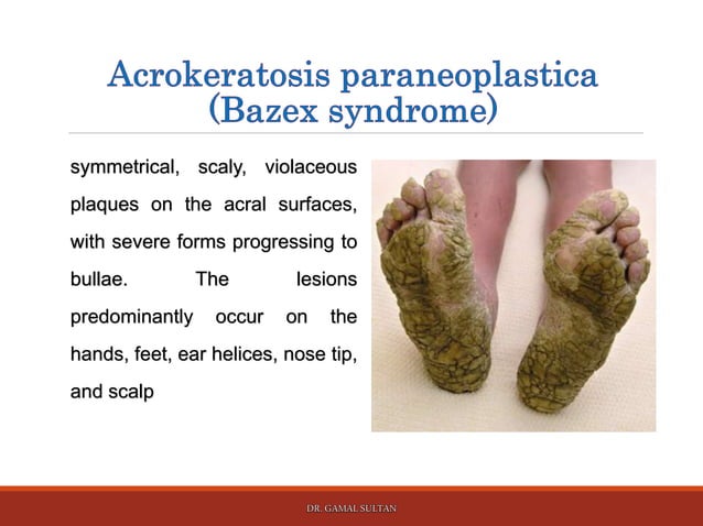 Cutaneous manifestations of internal malignancy and paraneoplastic ...