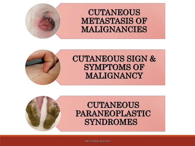 Cutaneous manifestations of internal malignancy and paraneoplastic ...