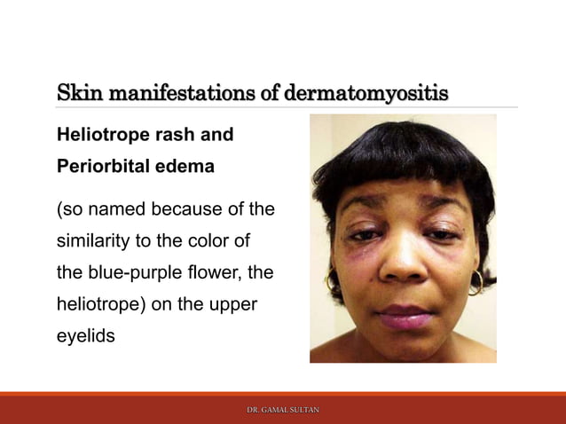 Cutaneous manifestations of internal malignancy and paraneoplastic ...