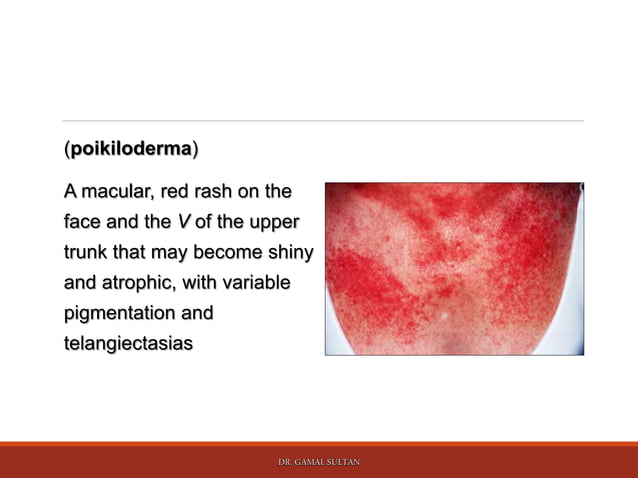 Cutaneous manifestations of internal malignancy and paraneoplastic ...