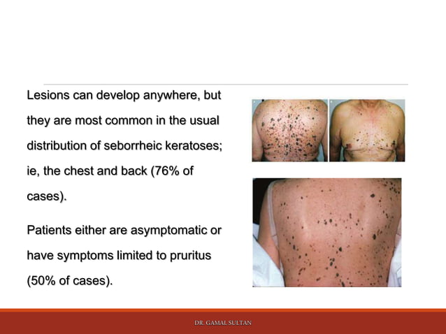 Cutaneous manifestations of internal malignancy and paraneoplastic ...