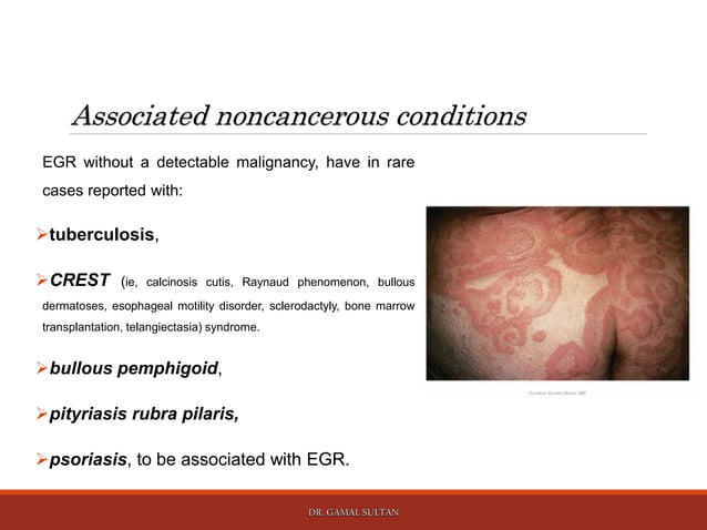 Cutaneous manifestations of internal malignancy and paraneoplastic ...
