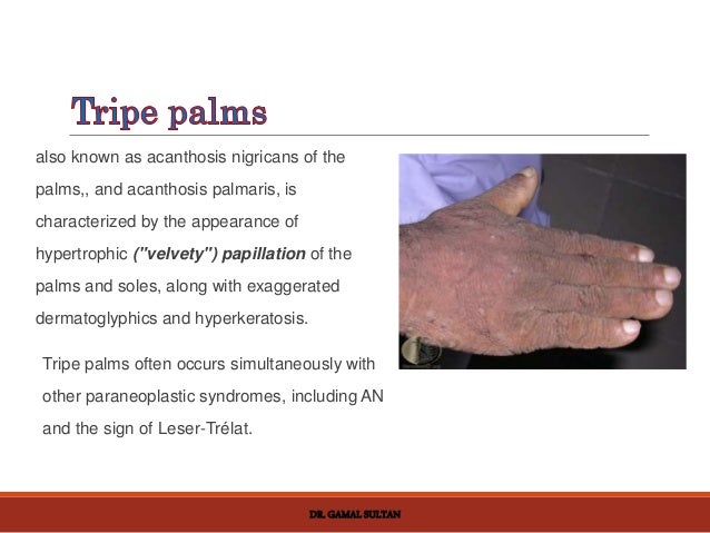 Cutaneous manifestations of internal malignancy and paraneoplastic sy…