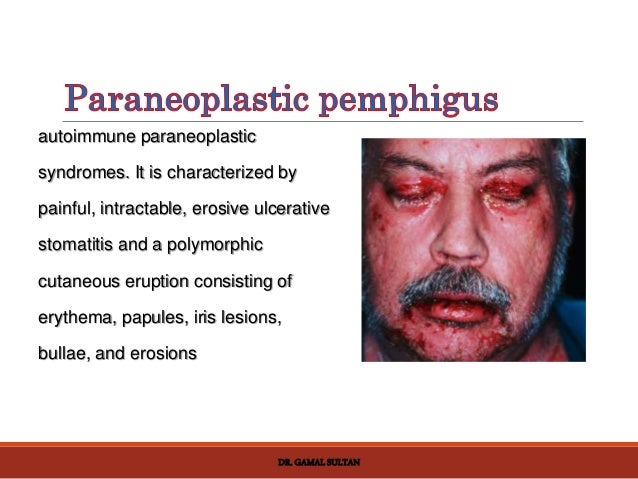 Cutaneous manifestations of internal malignancy and paraneoplastic sy…
