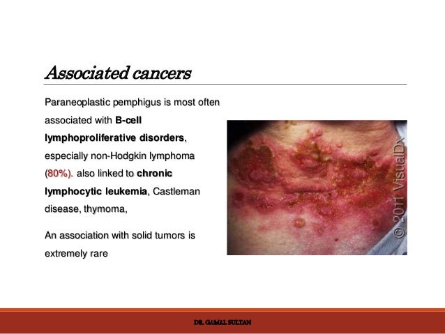 Cutaneous manifestations of internal malignancy and paraneoplastic sy…
