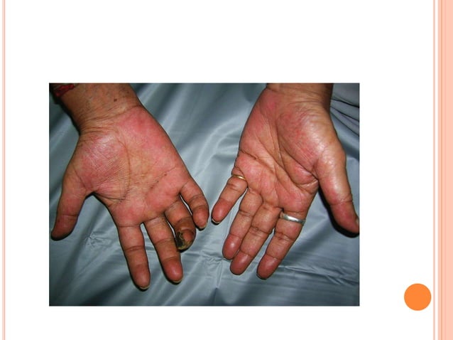 Cutaneous manifestations of rheumatoid arthritis | PPTX | Skin and ...