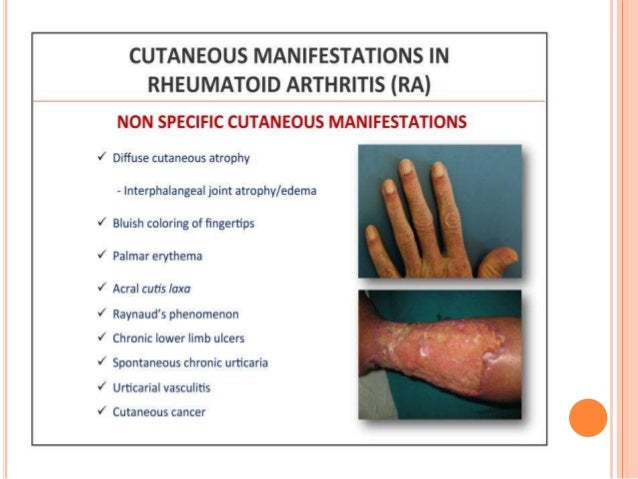 Cutaneous manifestations of rheumatoid arthritis