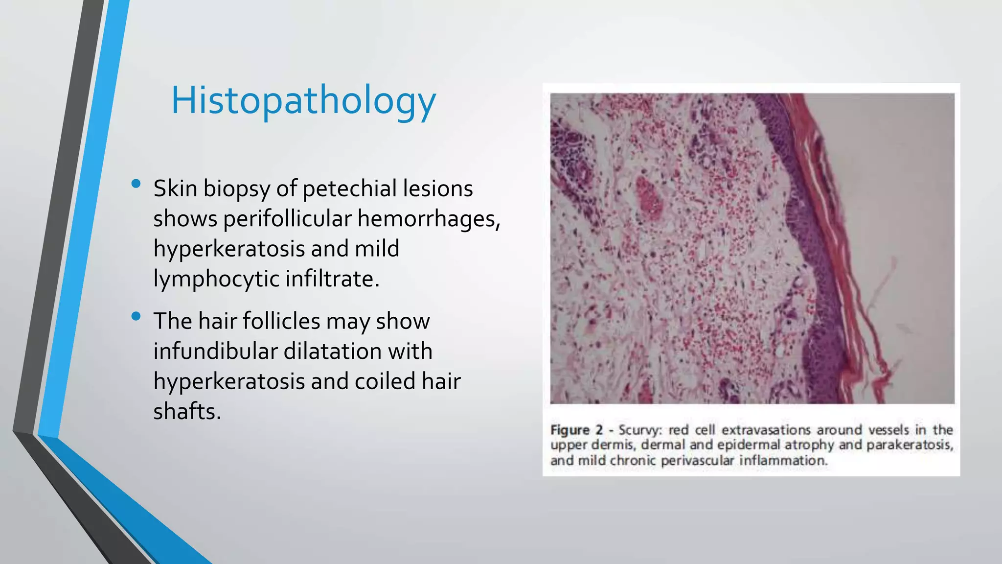 Cutaneous Manifestations of Vitamin C Deficiency | PPT
