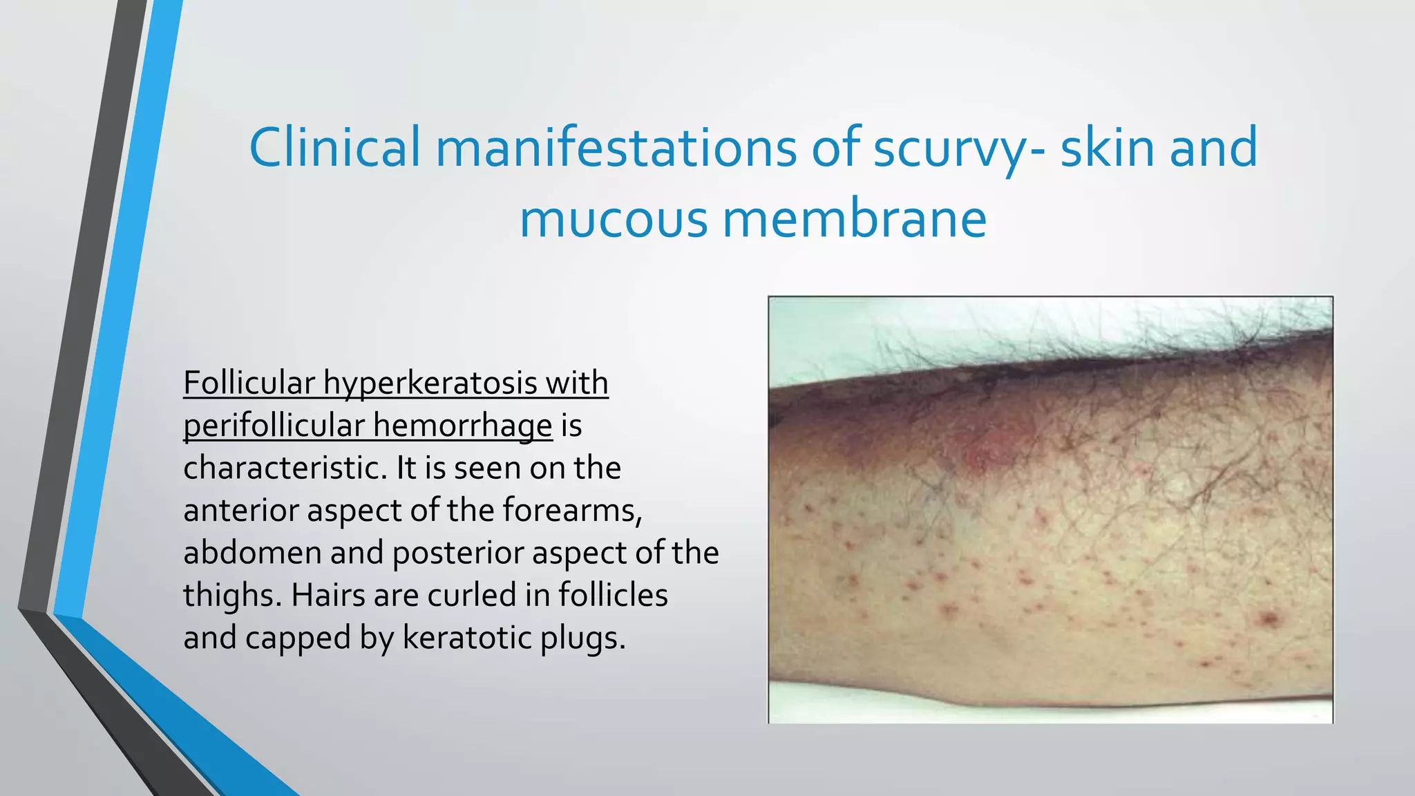 Cutaneous Manifestations of Vitamin C Deficiency | PPT