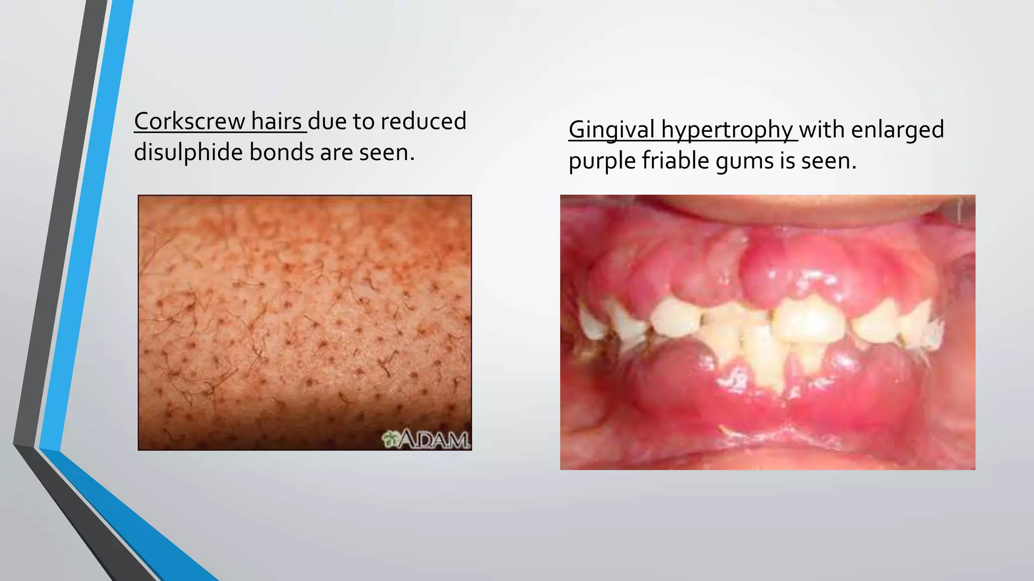 Cutaneous Manifestations of Vitamin C Deficiency | PPT