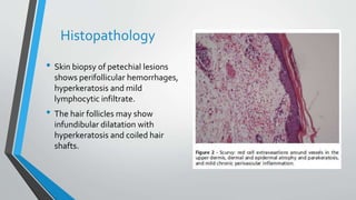 Cutaneous Manifestations of Vitamin C Deficiency | PPT