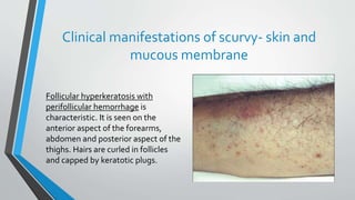 Cutaneous Manifestations of Vitamin C Deficiency | PPTX