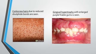 Cutaneous Manifestations of Vitamin C Deficiency | PPT