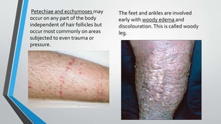 Cutaneous Manifestations of Vitamin C Deficiency | PPT