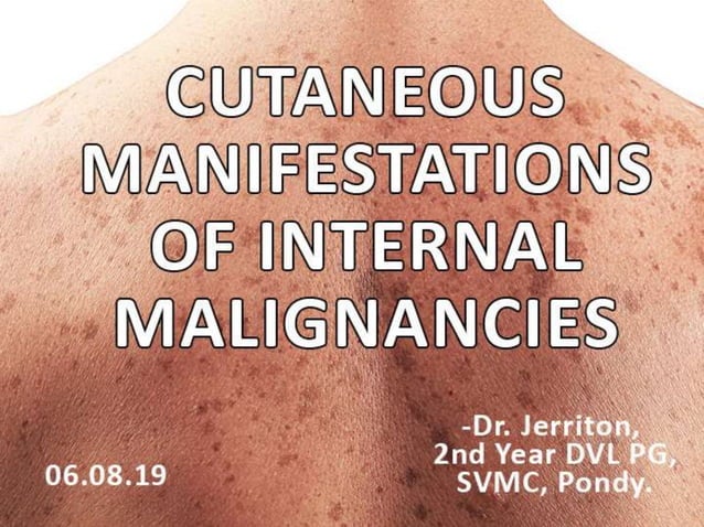 Cutaneous Manifestations of Internal Malignancies | PPTX | Skin and ...