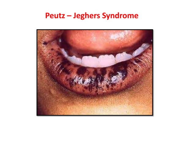 Cutaneous Manifestations of Internal Malignancies | PPTX | Skin and ...