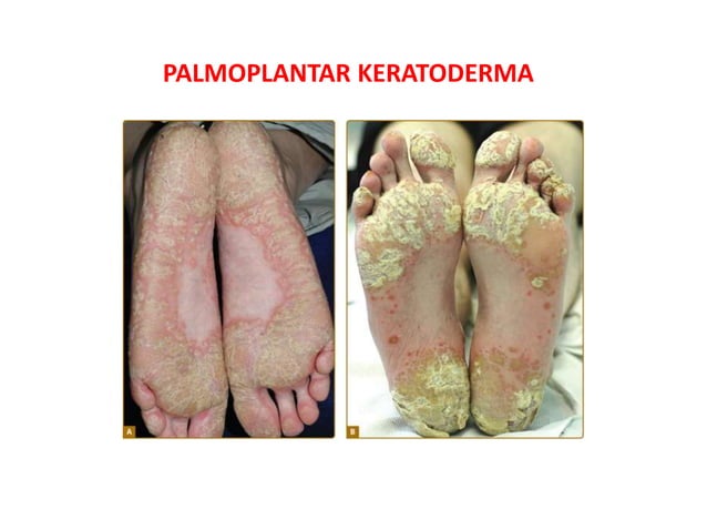 Cutaneous Manifestations of Internal Malignancies | PPTX | Skin and ...