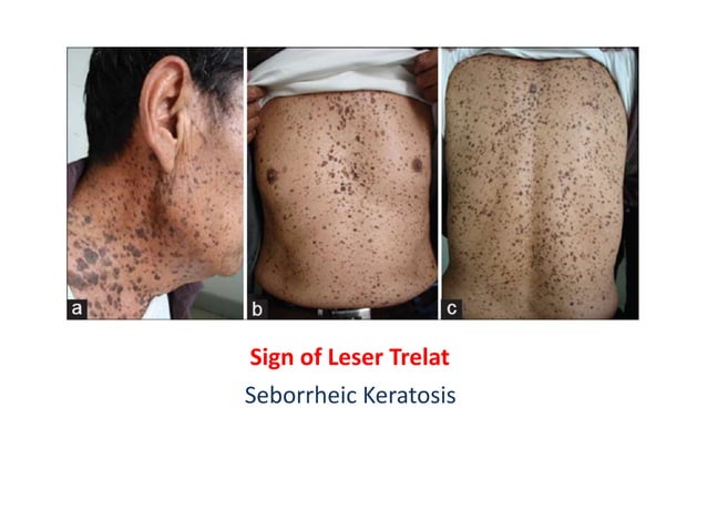 Cutaneous Manifestations of Internal Malignancies | PPTX | Skin and ...