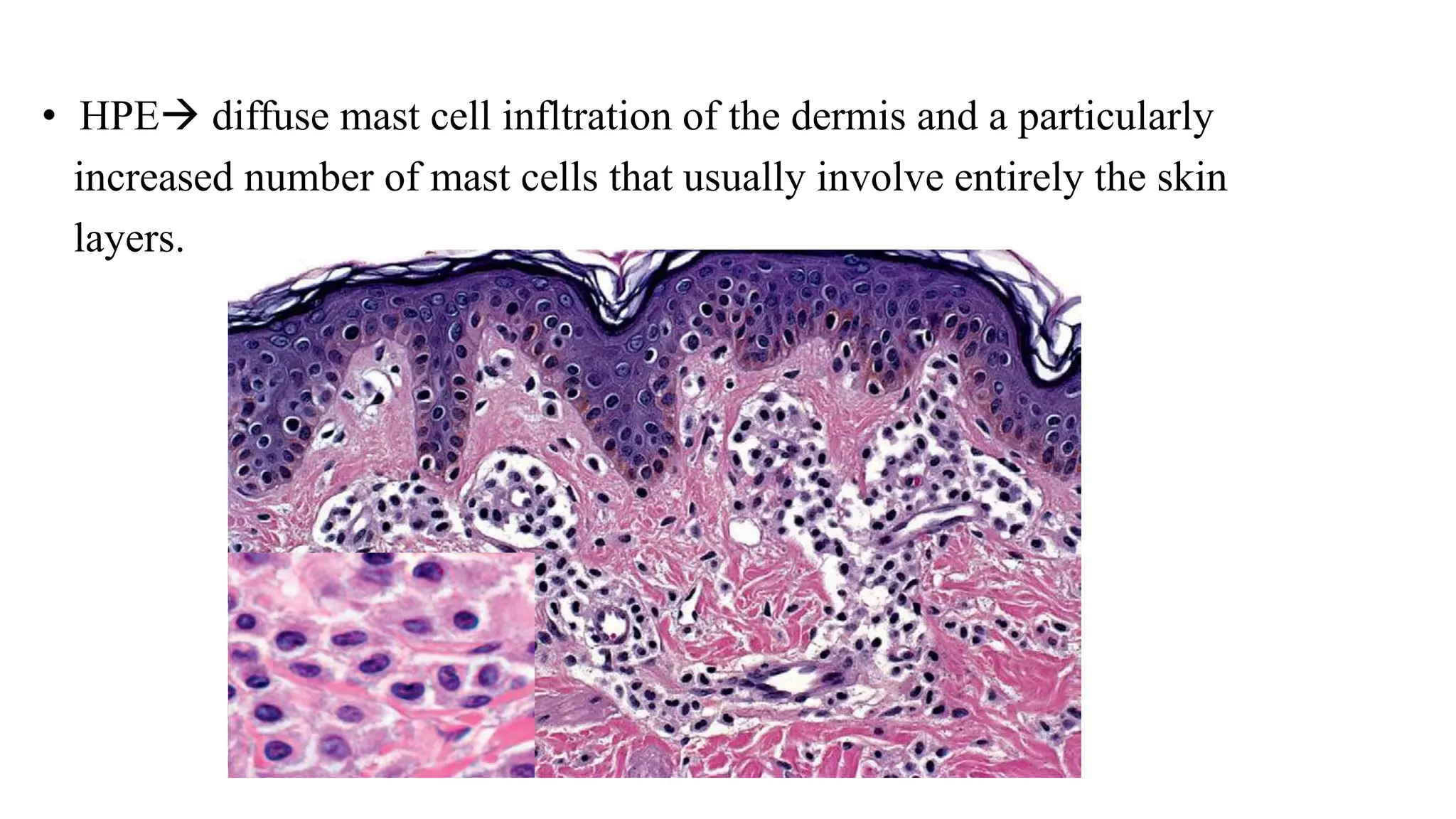 CUTANEOUS MASTOCYTOSIS.pptx ( MANIFESTATIONS AND MANAGEMENT) | PPT