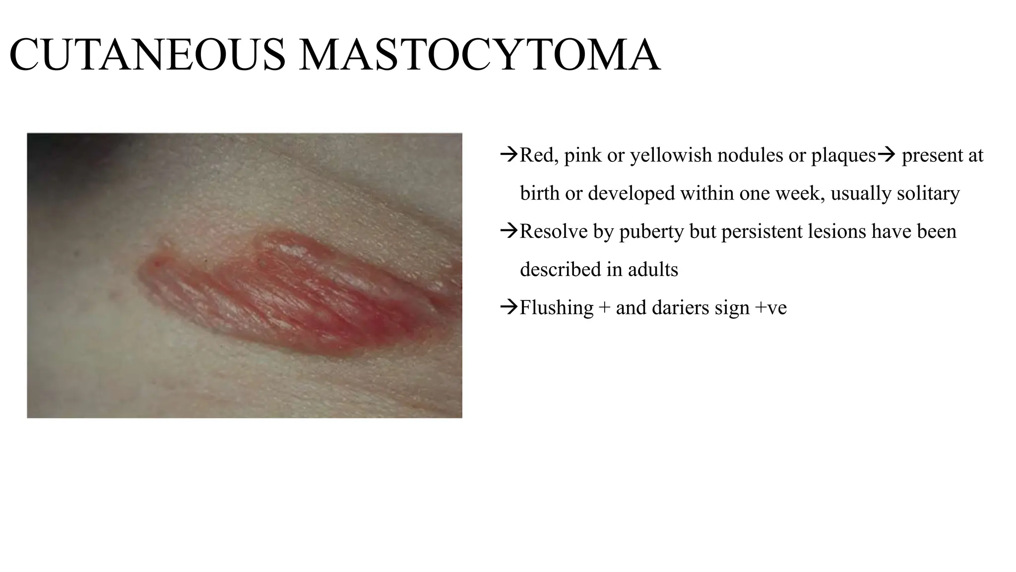 CUTANEOUS MASTOCYTOSIS.pptx ( MANIFESTATIONS AND MANAGEMENT) | PPT