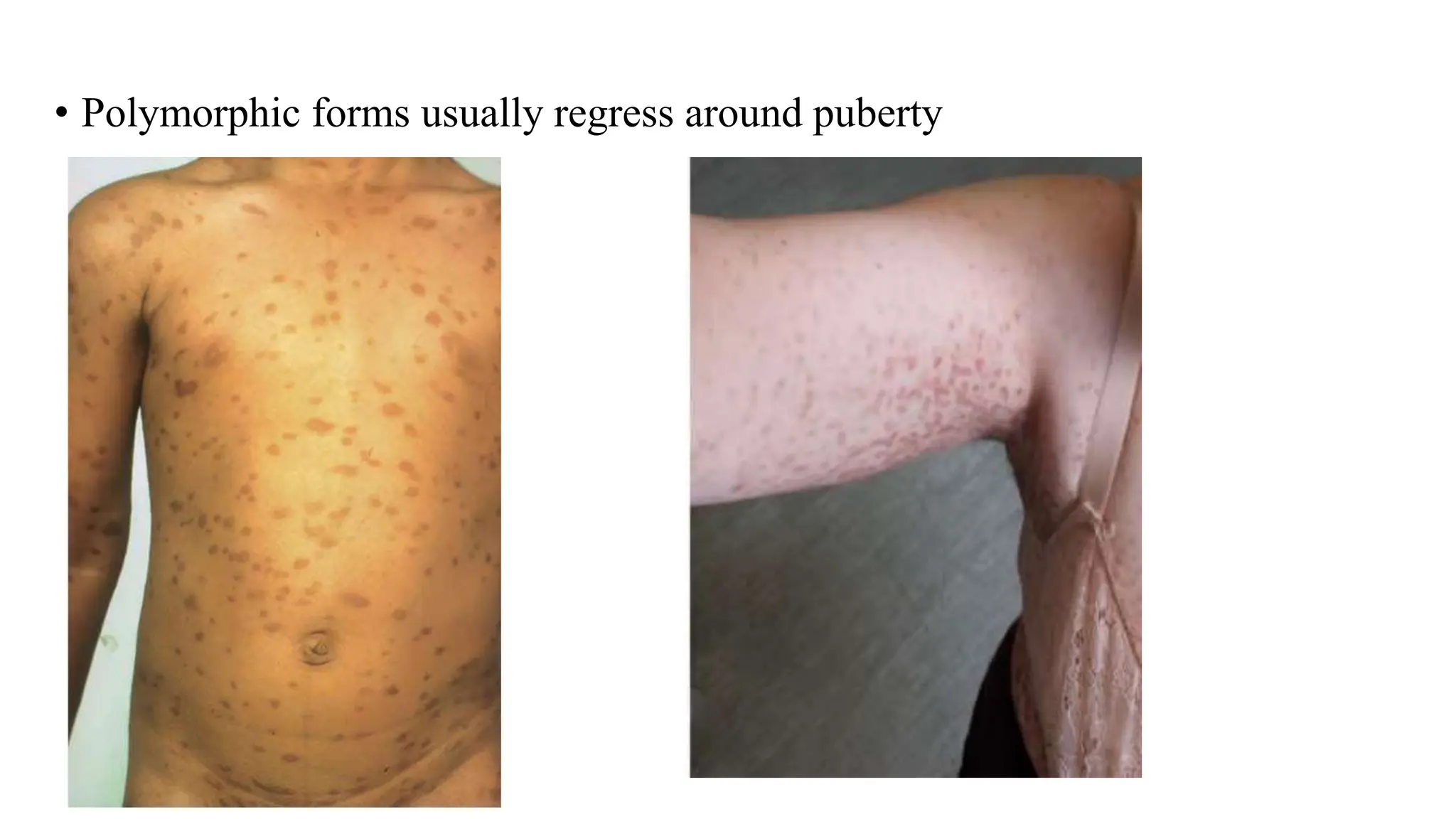 CUTANEOUS MASTOCYTOSIS.pptx ( MANIFESTATIONS AND MANAGEMENT) | PPT