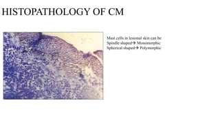 CUTANEOUS MASTOCYTOSIS.pptx ( MANIFESTATIONS AND MANAGEMENT) | PPTX