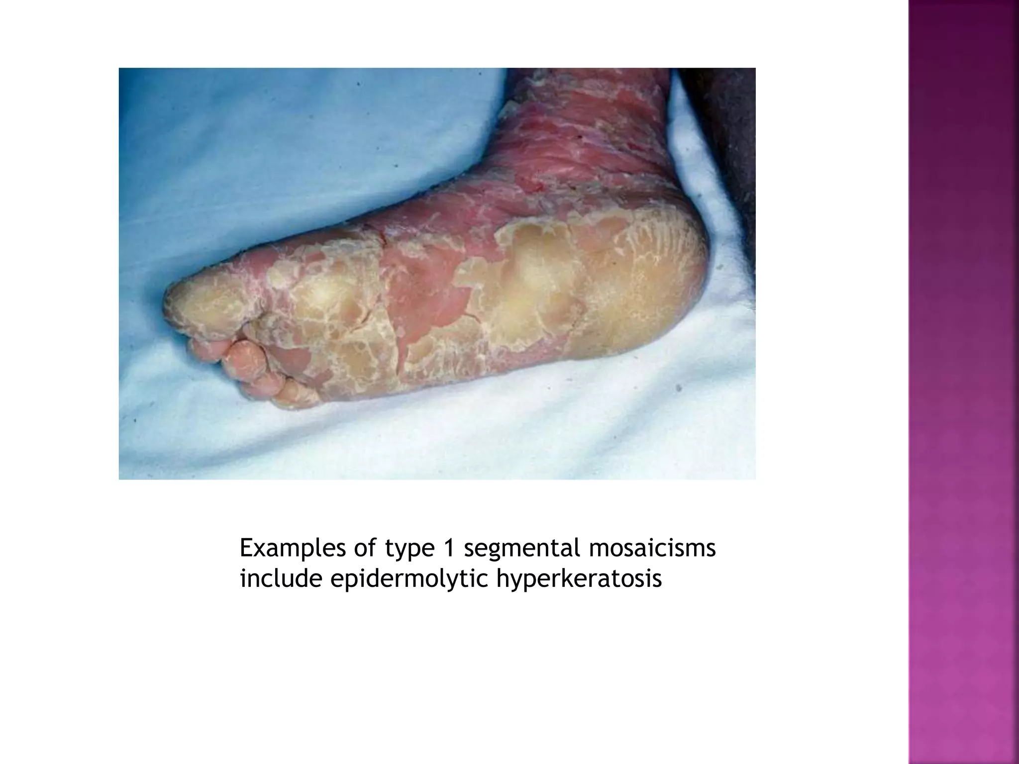 Cutaneous Mosaicisms: Concepts, Patterns, and Classifications - Dr ...