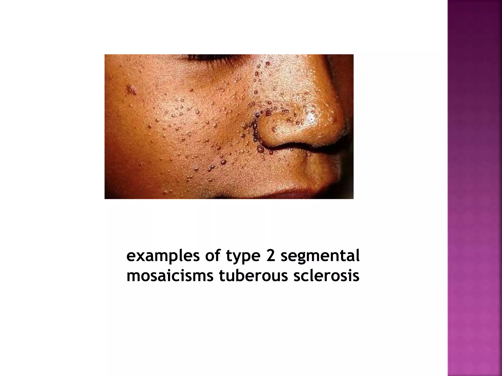 Cutaneous Mosaicisms: Concepts, Patterns, and Classifications - Dr ...