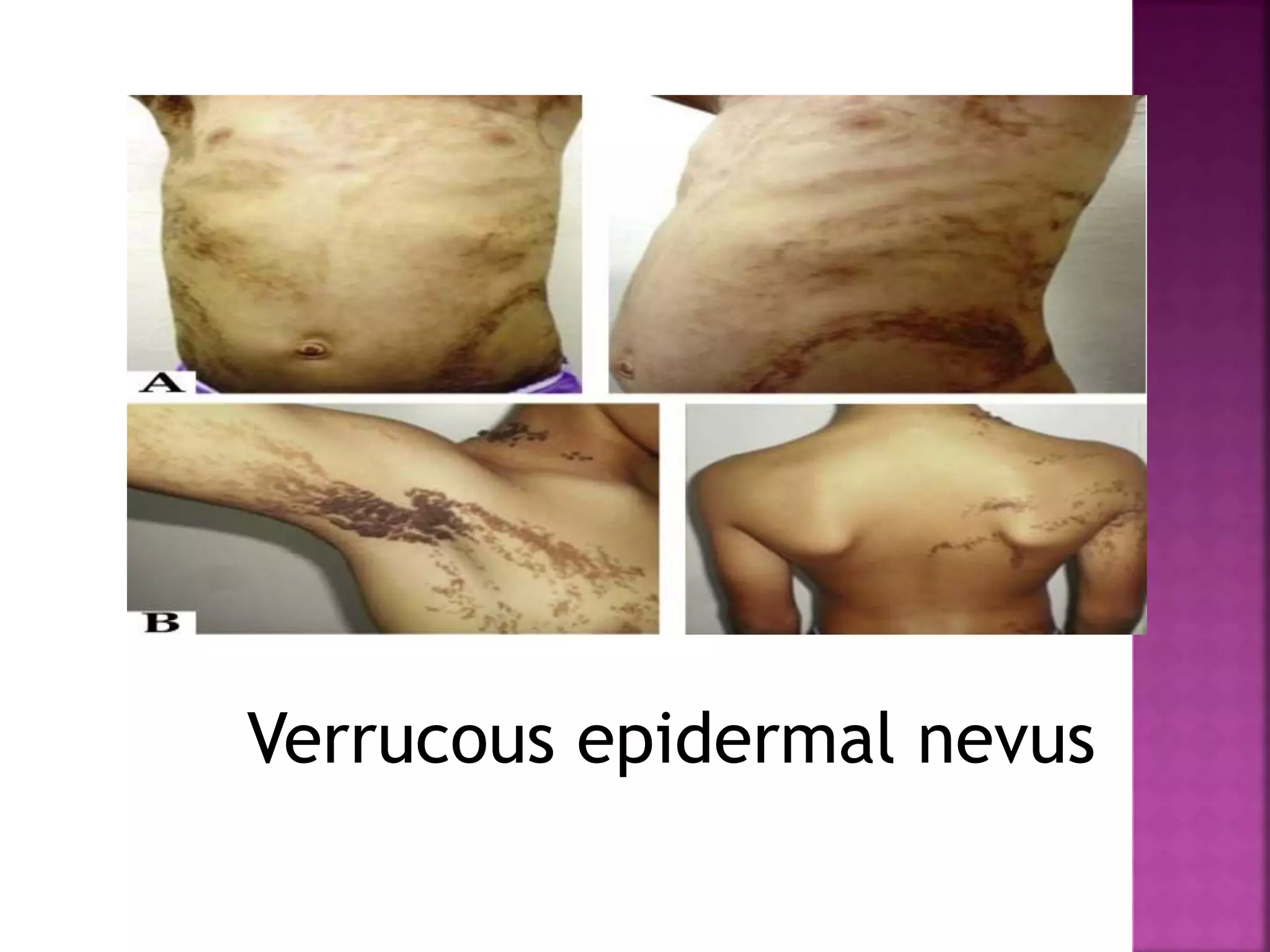 Cutaneous Mosaicisms: Concepts, Patterns, and Classifications - Dr ...