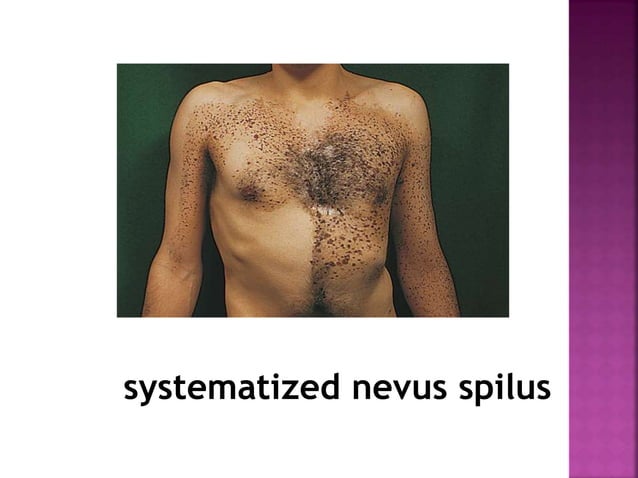 Cutaneous Mosaicisms: Concepts, Patterns, and Classifications - Dr ...