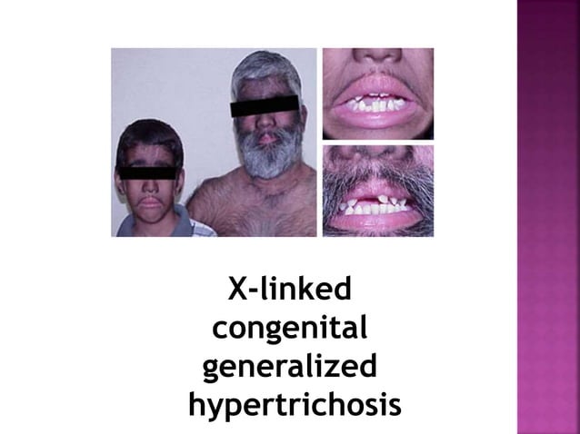 Cutaneous Mosaicisms: Concepts, Patterns, and Classifications - Dr ...