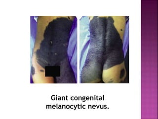 Cutaneous Mosaicisms: Concepts, Patterns, and Classifications - Dr ...