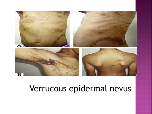 Cutaneous Mosaicisms: Concepts, Patterns, and Classifications - Dr ...